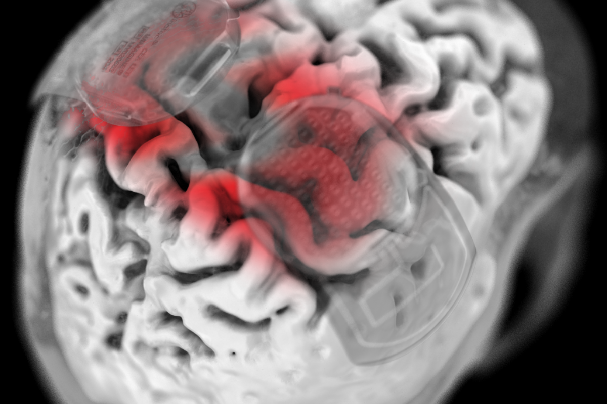 Onward Medical: A Ground-breaking External Spinal Cord Stimulation Device